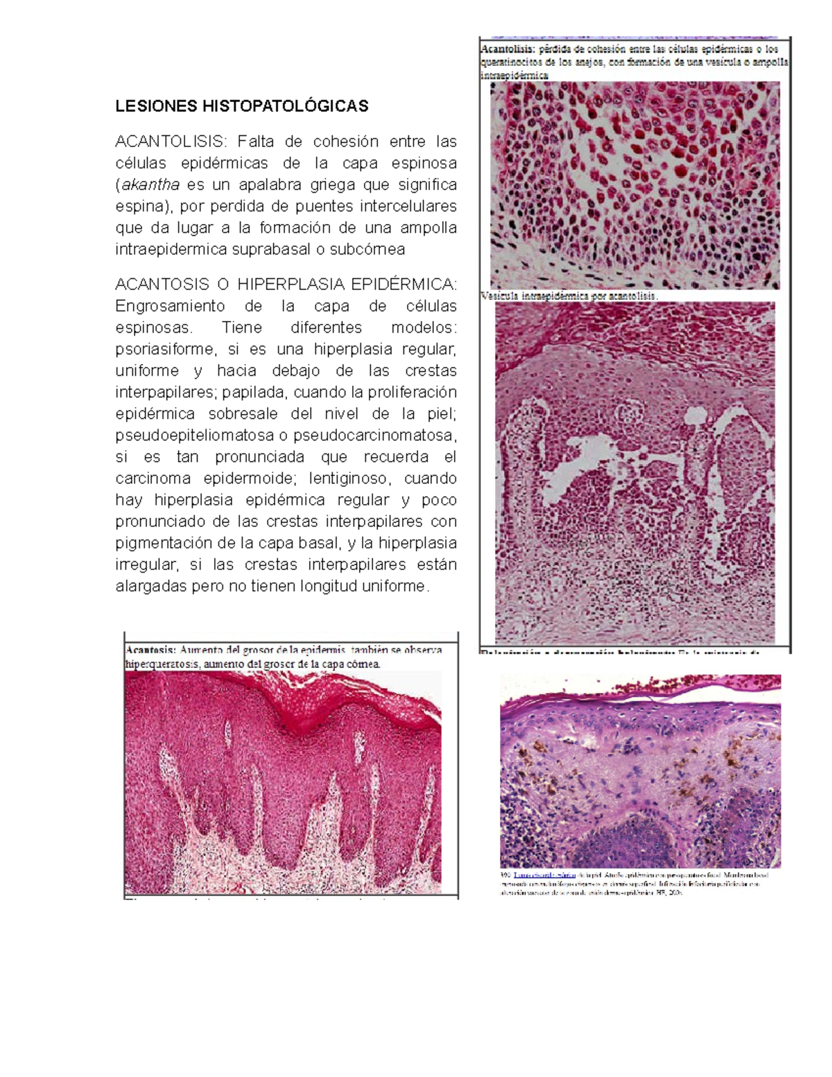Lesiones histo - Apuntes 1 - LESIONES HISTOPATOLÓGICAS ACANTOLISIS ...