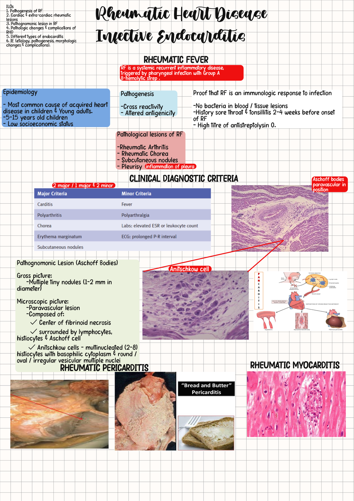 Rheumatic & Infective Endocarditis - ILOs 1. Pathogenesis of RF 2 ...