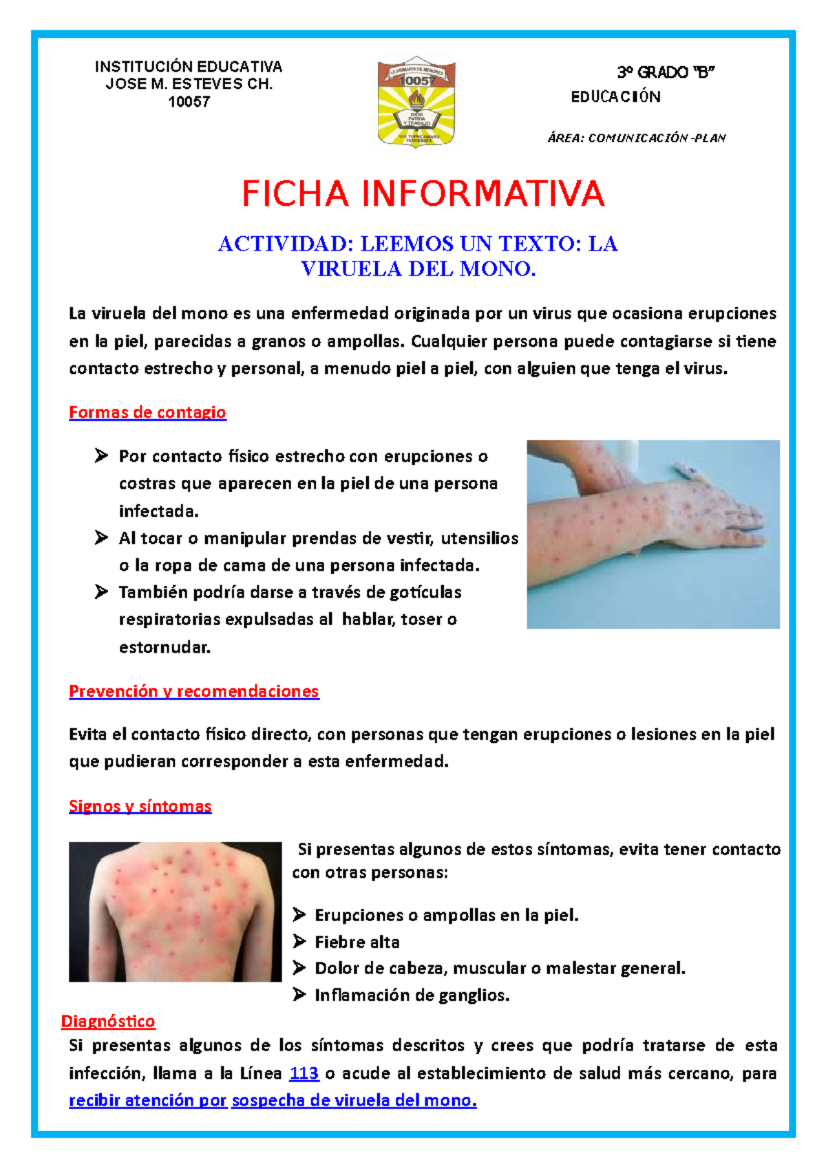 Ficha Informativa- Viruela DEL MONO - FICHA INFORMATIVA ACTIVIDAD ...