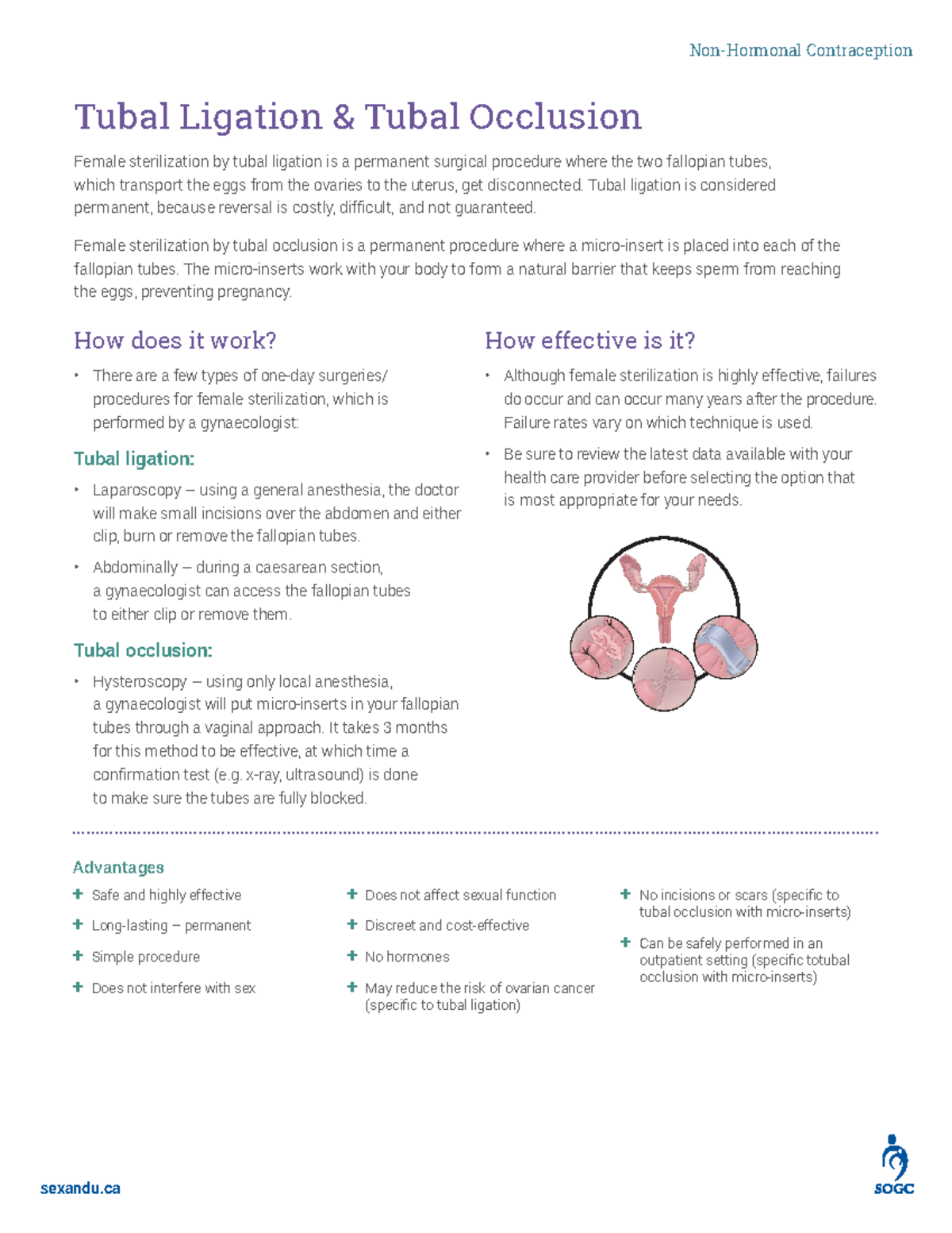 Tubal Ligation Occlusion - sexandu Tubal Ligation & Tubal Occlusion ...