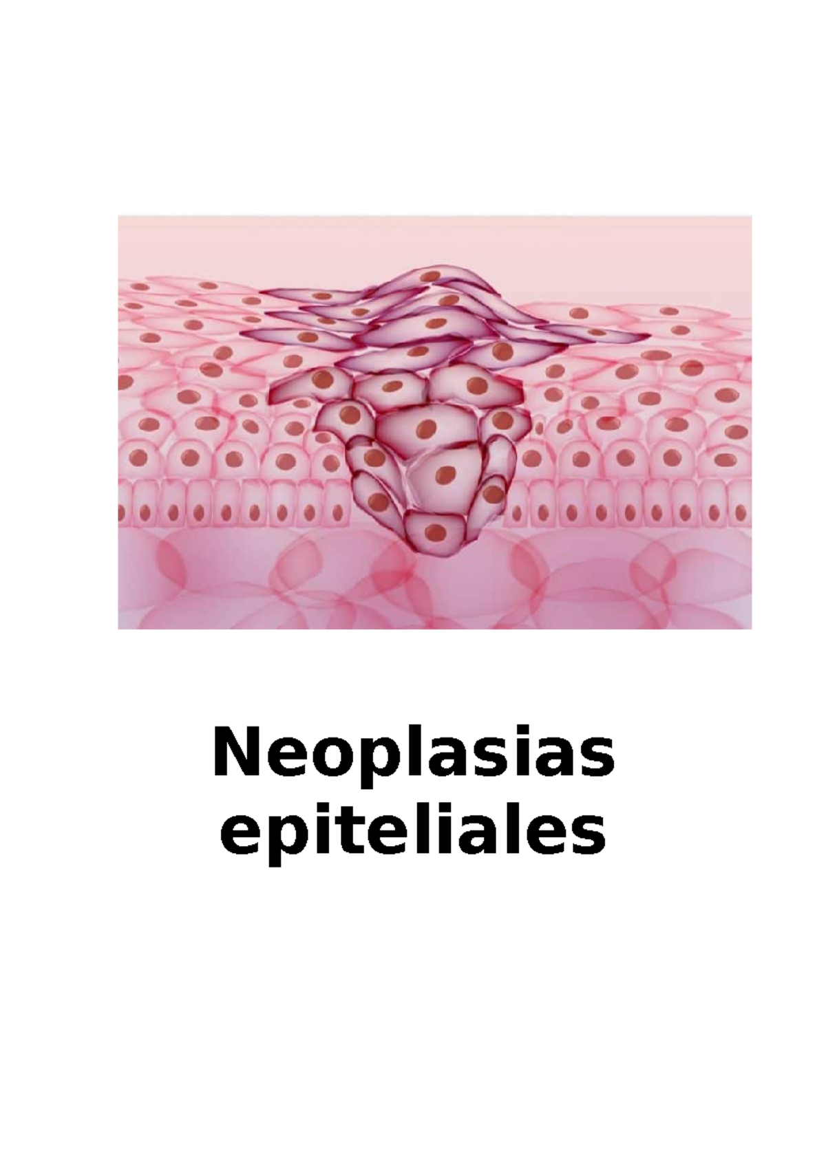 Neoplasias epiteliales - Neoplasias epiteliales La neoplasia Es también ...