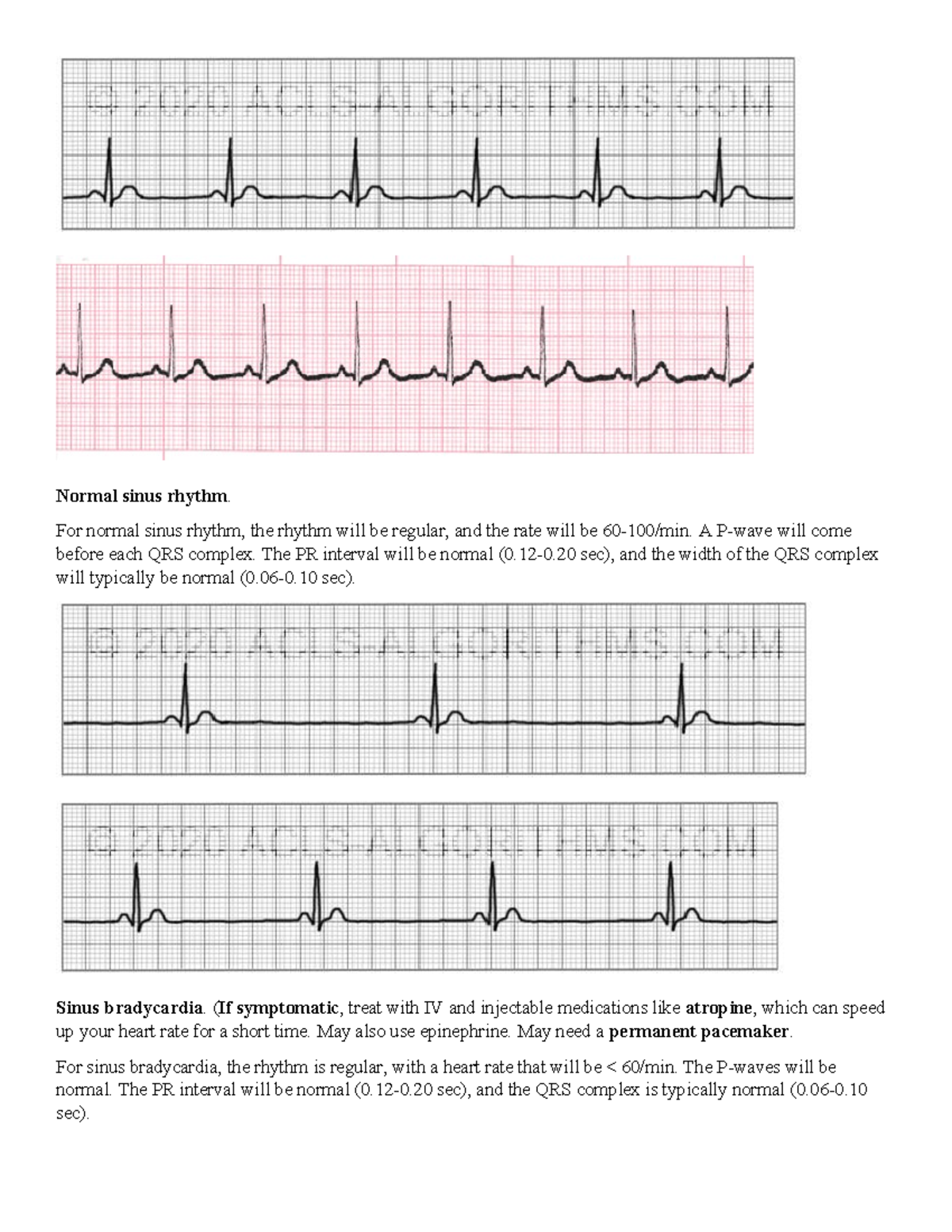 Cardiac Rhythms treatment - Normal sinus rhythm. For normal sinus ...
