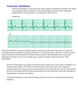 ECG reading materials with direct example for practice - ACLS EKG STUDY ...