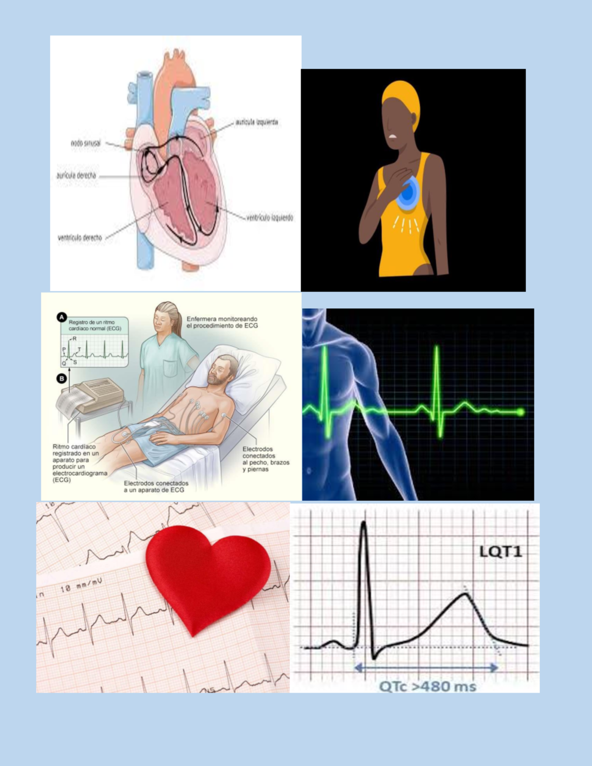Sindrome DE QT Largo - tarea - El síndrome de QT largo es un trastorno ...