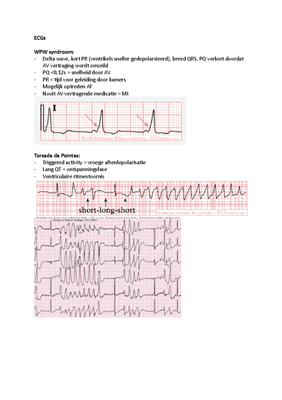 Overzicht van cardiale afwijkingen op het ECG - ECGs WPW syndroom: Delta wave, kort PR ...