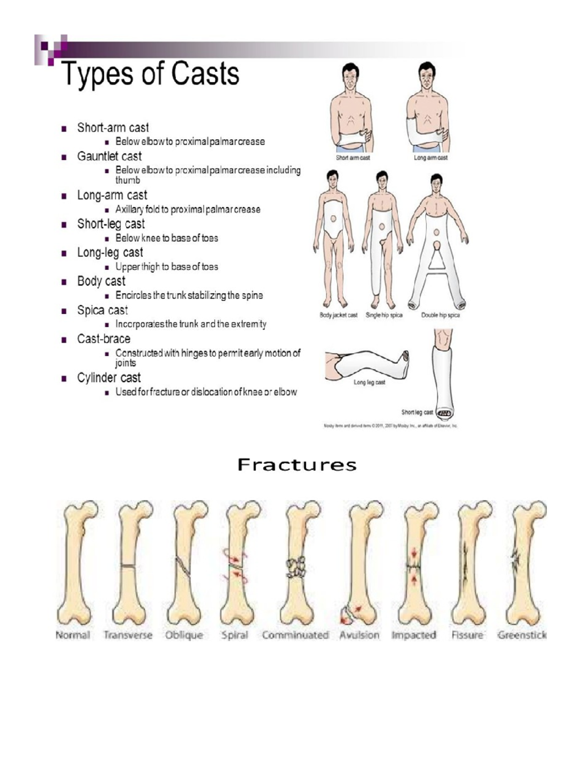 Cast - types of the cast, fracture, Duchenne's muscular dystrophy, and ...