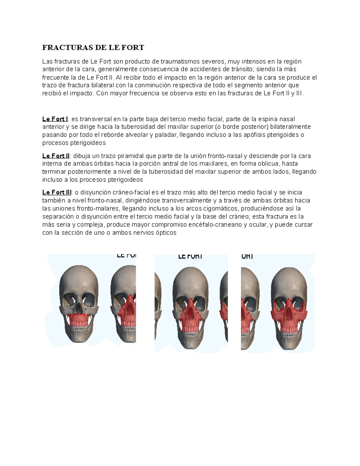 Fracturas DE LE FORT - apunte rapido - FRACTURAS DE LE FORT Las ...