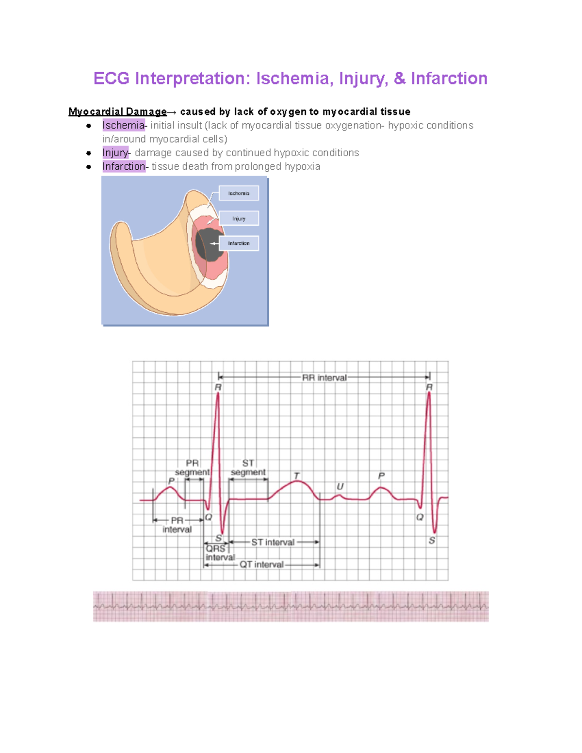ECG Interpretation notes - ECG Interpretation: Ischemia, Injury ...