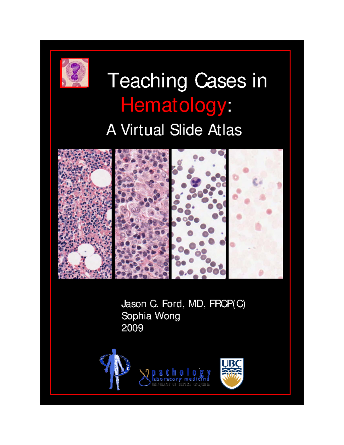 Hemepath Cases 1 - For hematological studies - Jason C. Ford, MD, FRCP(C) Sophia Wong Teaching ...