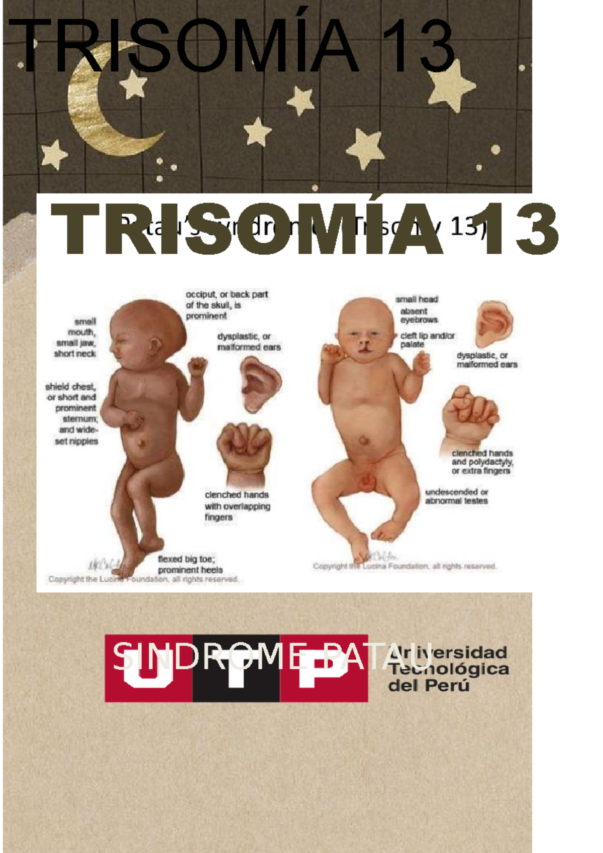 Trisomia 13 - ASAS - TRISOMÍA 13 TRISOMÍA 13 SINDROME PATAU ...