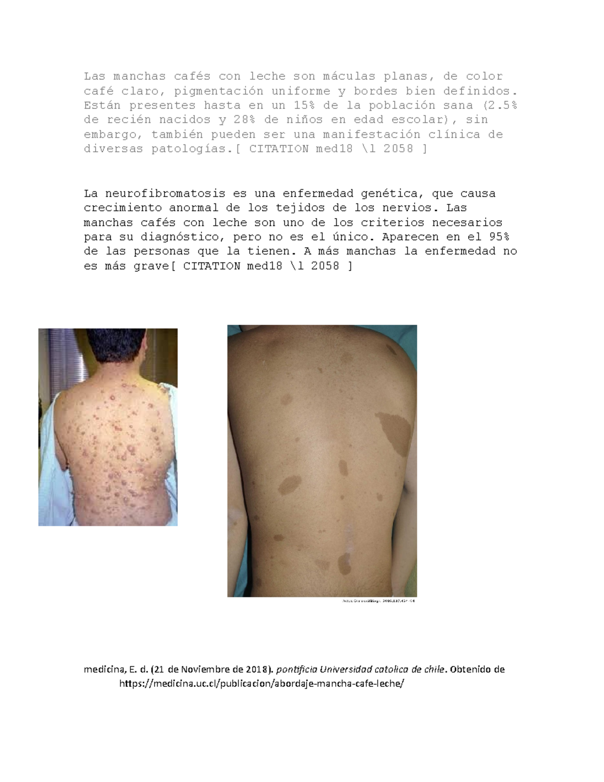 Manchas cafés con leche - Las manchas cafés con leche son máculas ...