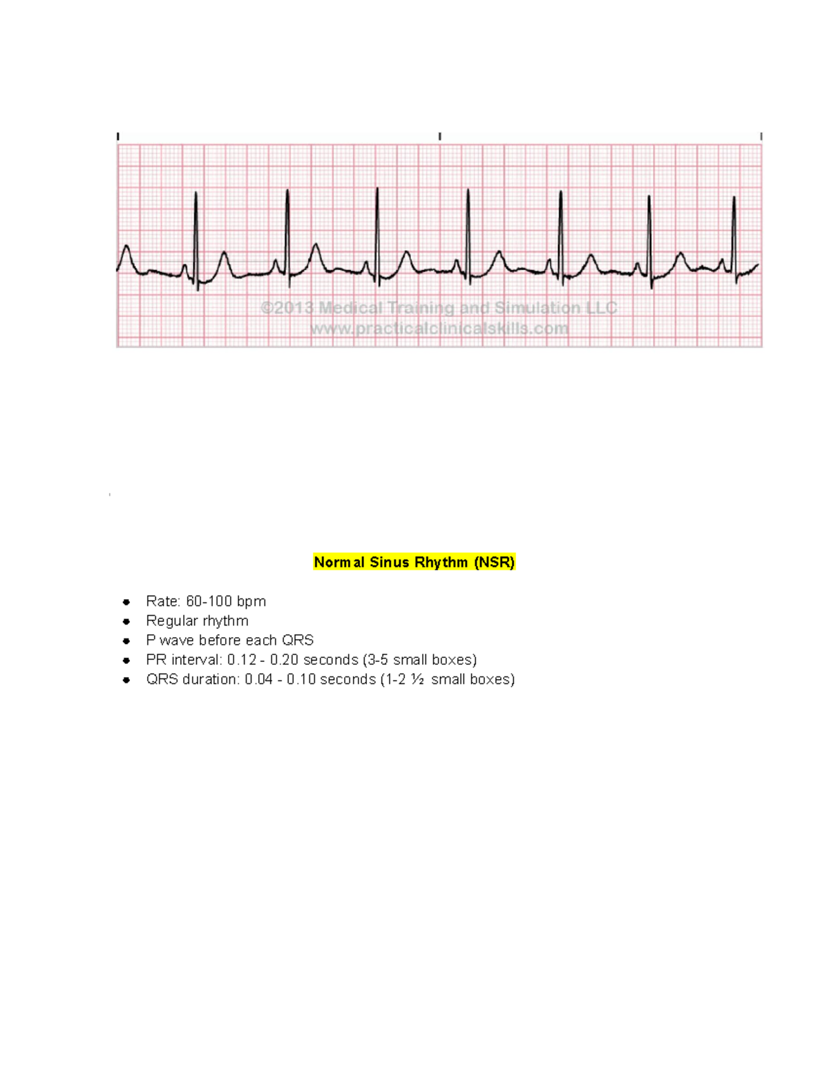 EKG strips - Normal Sinus Rhythm (NSR) Rate: 60-100 bpm Regular rhythm ...