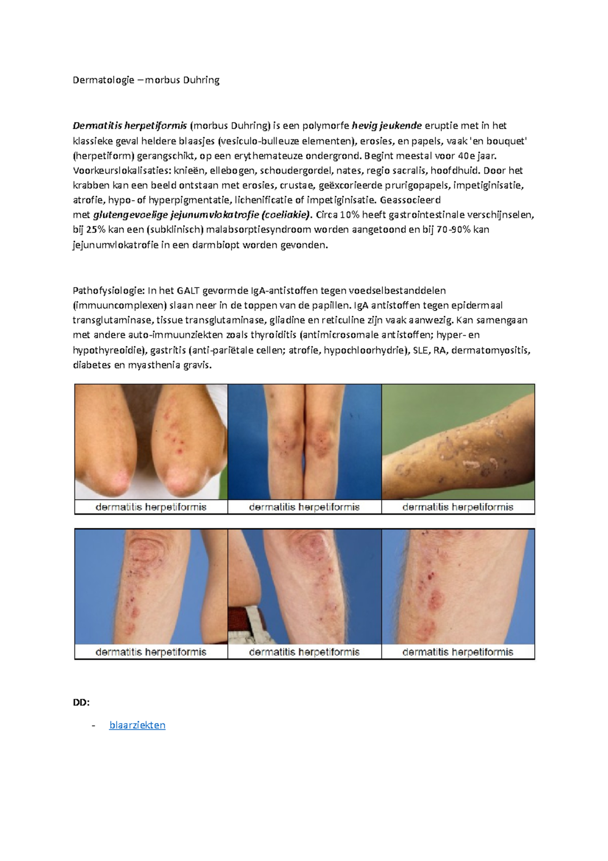Dermatologie - morbus duhring - Dermatologie – morbus Duhring ...