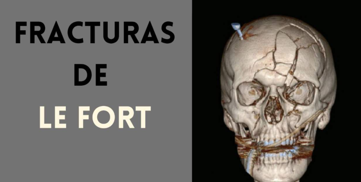 Fracturas de le fort - RENÉ L. LE FORT (1869 – 1951) - Lille, Francia A ...