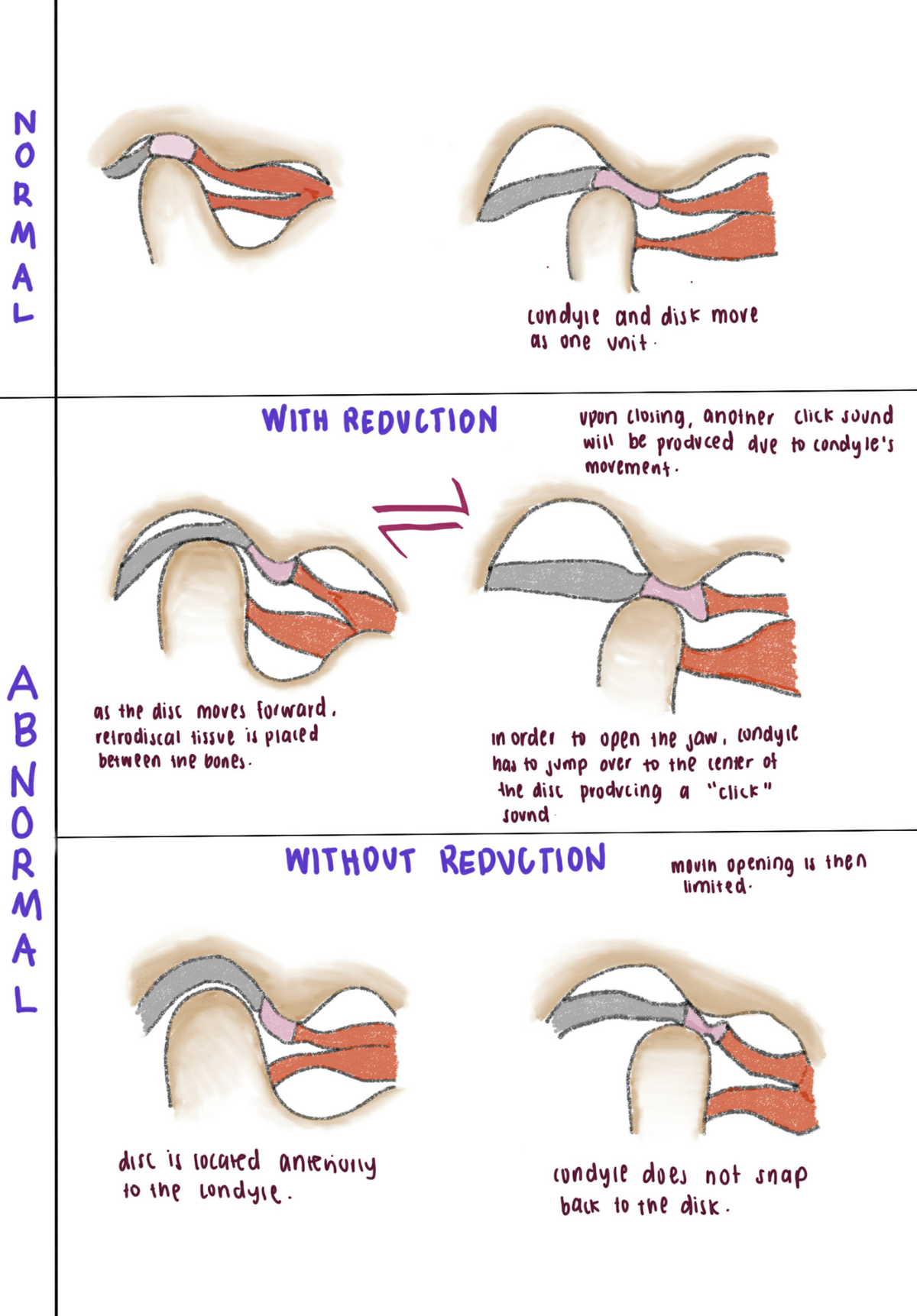 TMJ Notes - Drawing regarding the normal and abnormal functions of TMJ ...