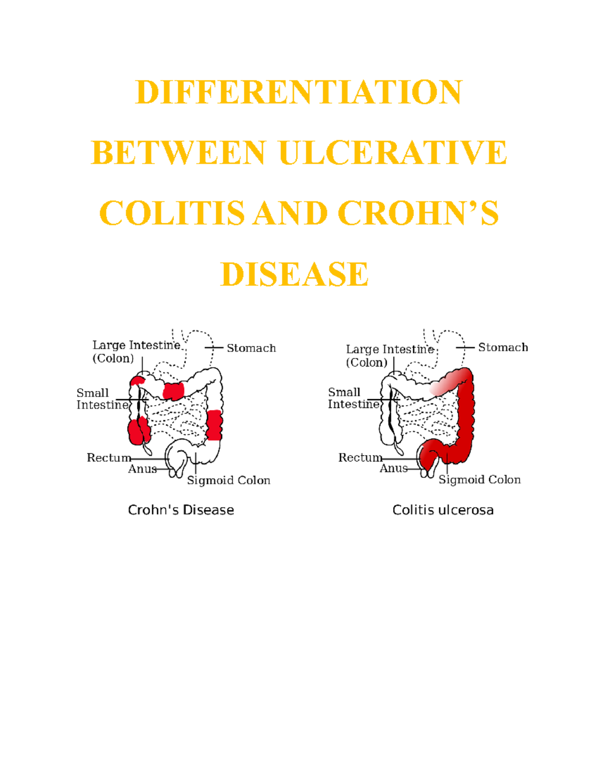 Comparison of ulcerative colitis and crohn's disease - DIFFERENTIATION ...
