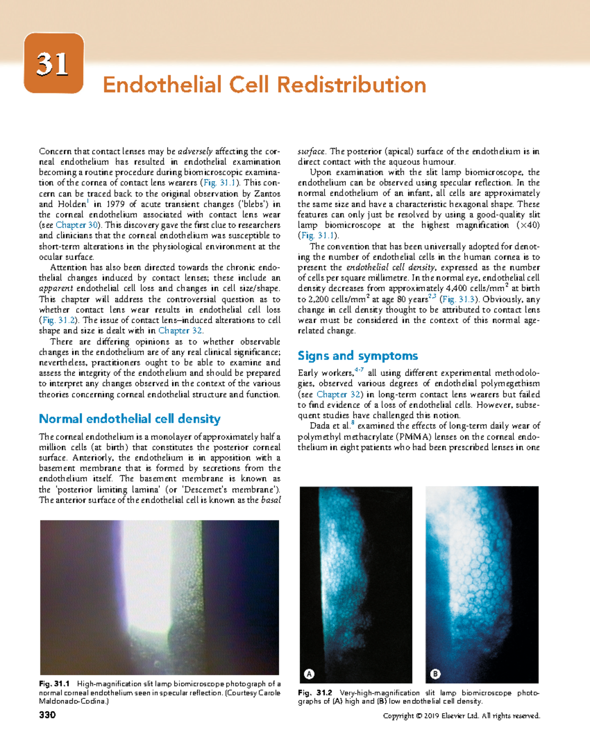 Endothelial Cell Redistribution Contact Lens Complications - 3131 ...