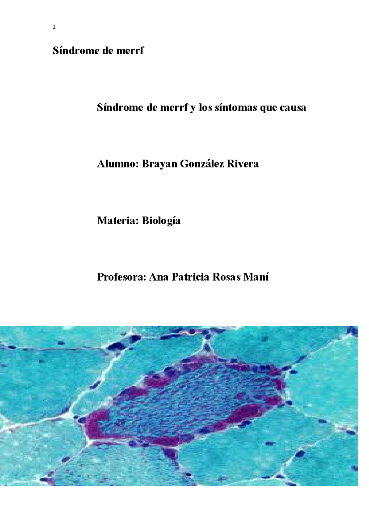 Sindrome de merrf - Apuntes 1 - Síndrome de merrf Síndrome de merrf y ...