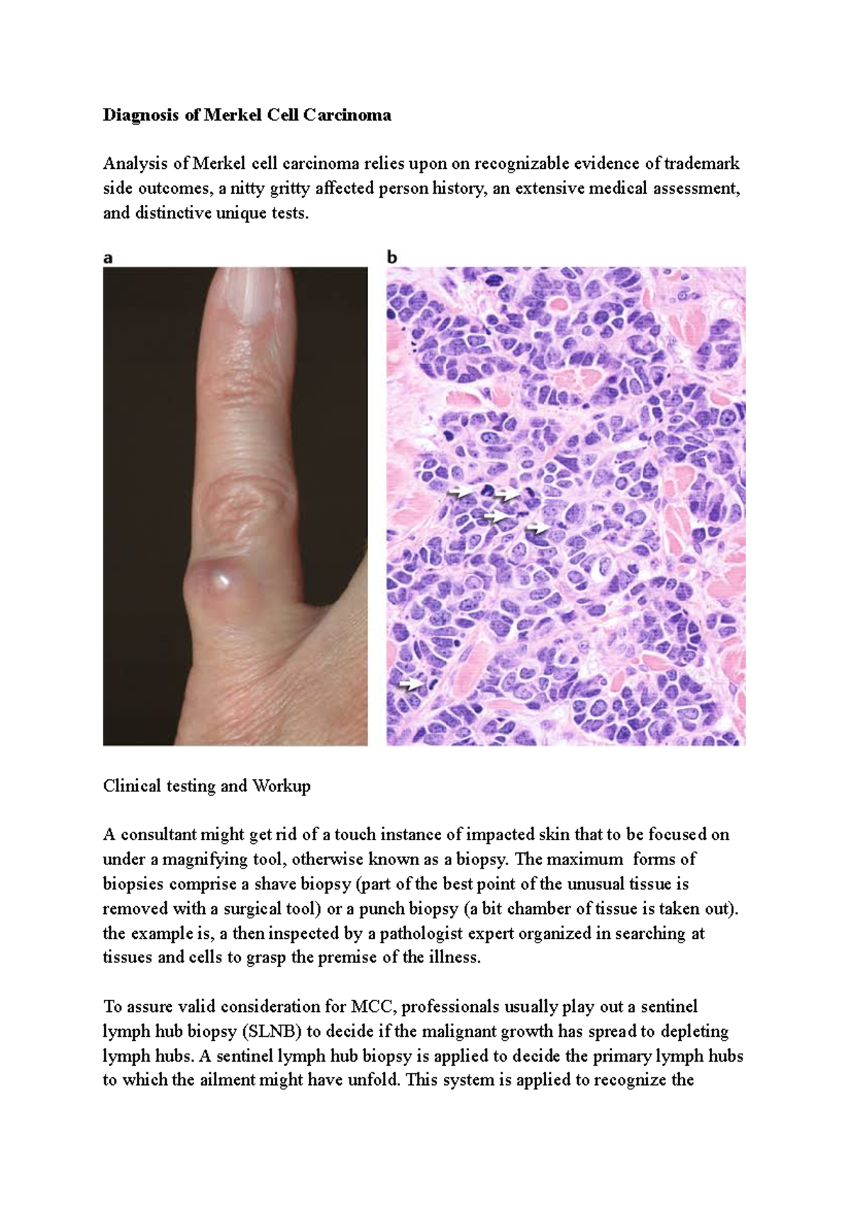 Diagnosis of Merkel Cell Carcinoma - Diagnosis of Merkel Cell Carcinoma ...