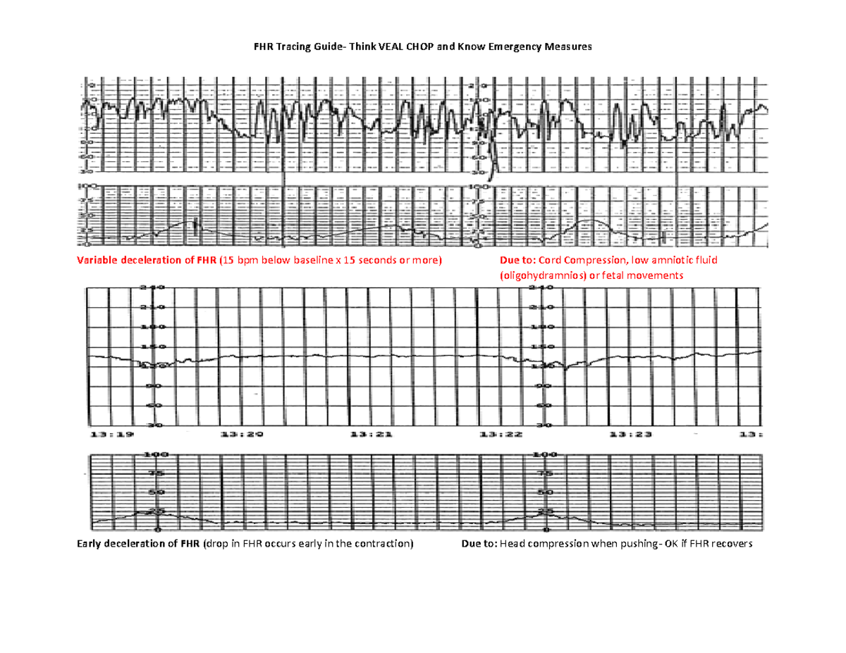 Electronic FHR Guide - sss - FHR Tracing Guide- Think VEAL CHOP and ...