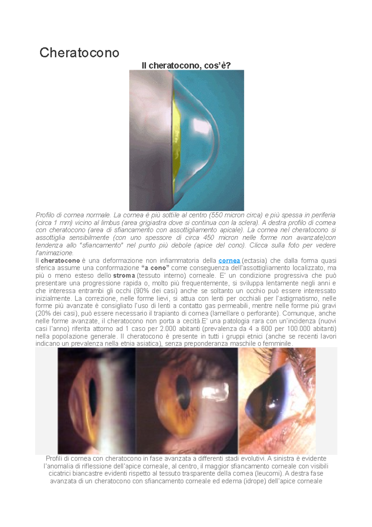 Cheratocono - Cheratocono Il cheratocono, cos’è? Profilo di cornea ...