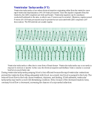 ECG reading materials with direct example for practice - ACLS EKG STUDY ...