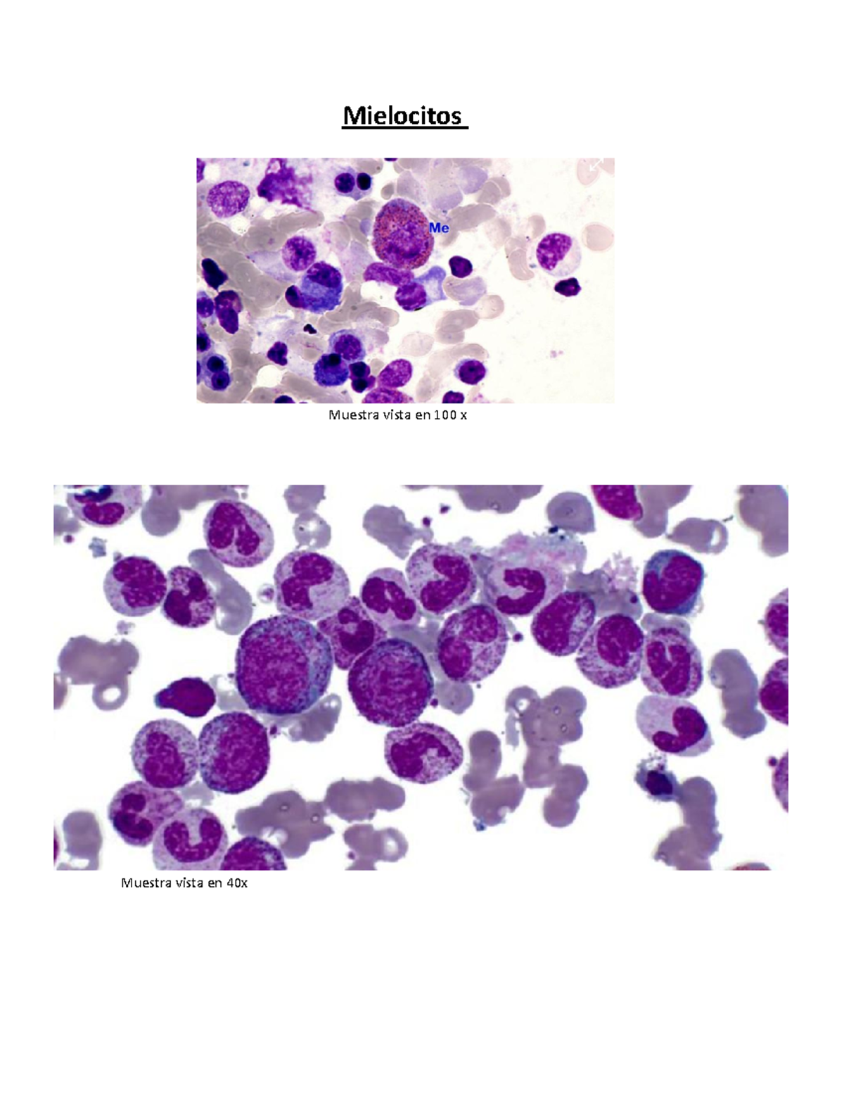 Mielocito y meramielocito - Mielocitos Muestra vista en 100 x Muestra ...