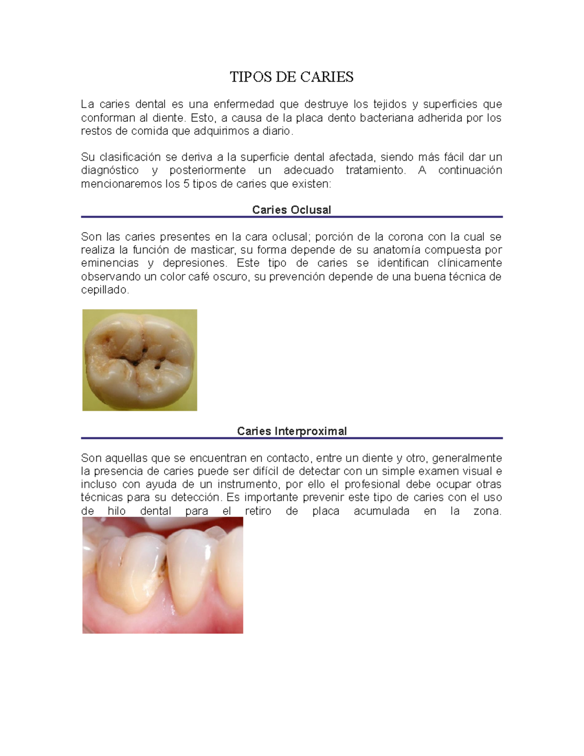 Tipos DE Caries - TIPOS DE CARIES La caries dental es una enfermedad ...