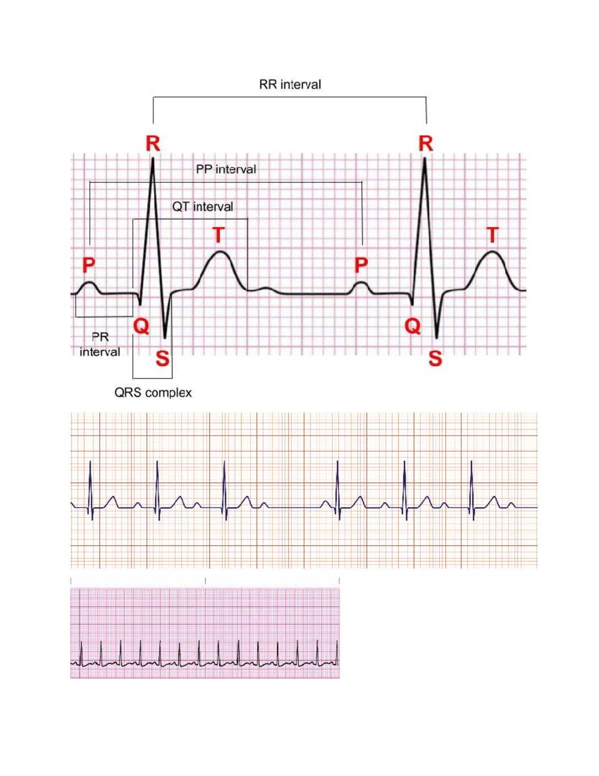 Ecg strips - n/a - 25:705:415 - Studocu