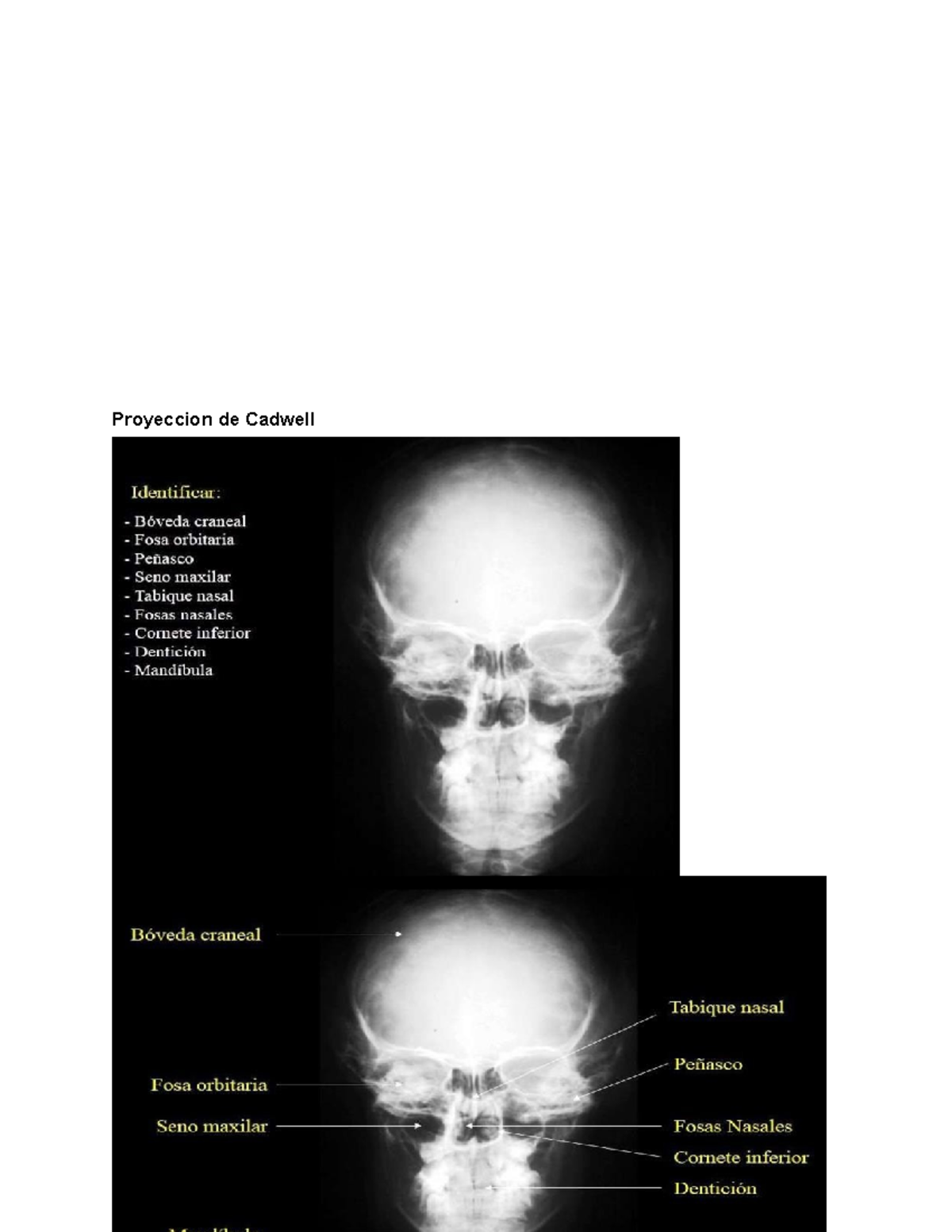 Tomografía axial computarizada - Proyeccion de Cadwell Proyeccion ...
