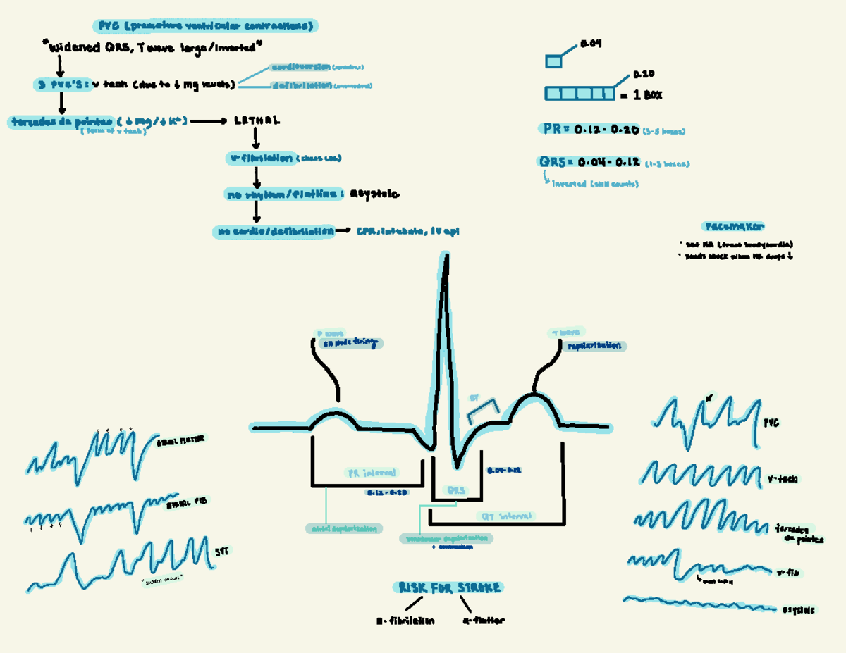 Heart rhythms and EKG - PVC (premature ventricular contractions ...