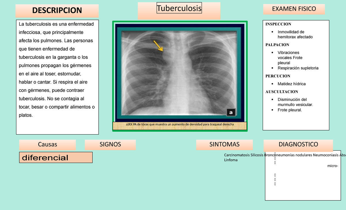 Tuberculosis - tuberulosissss - a)RX PA de tórax que muestra un aumento ...