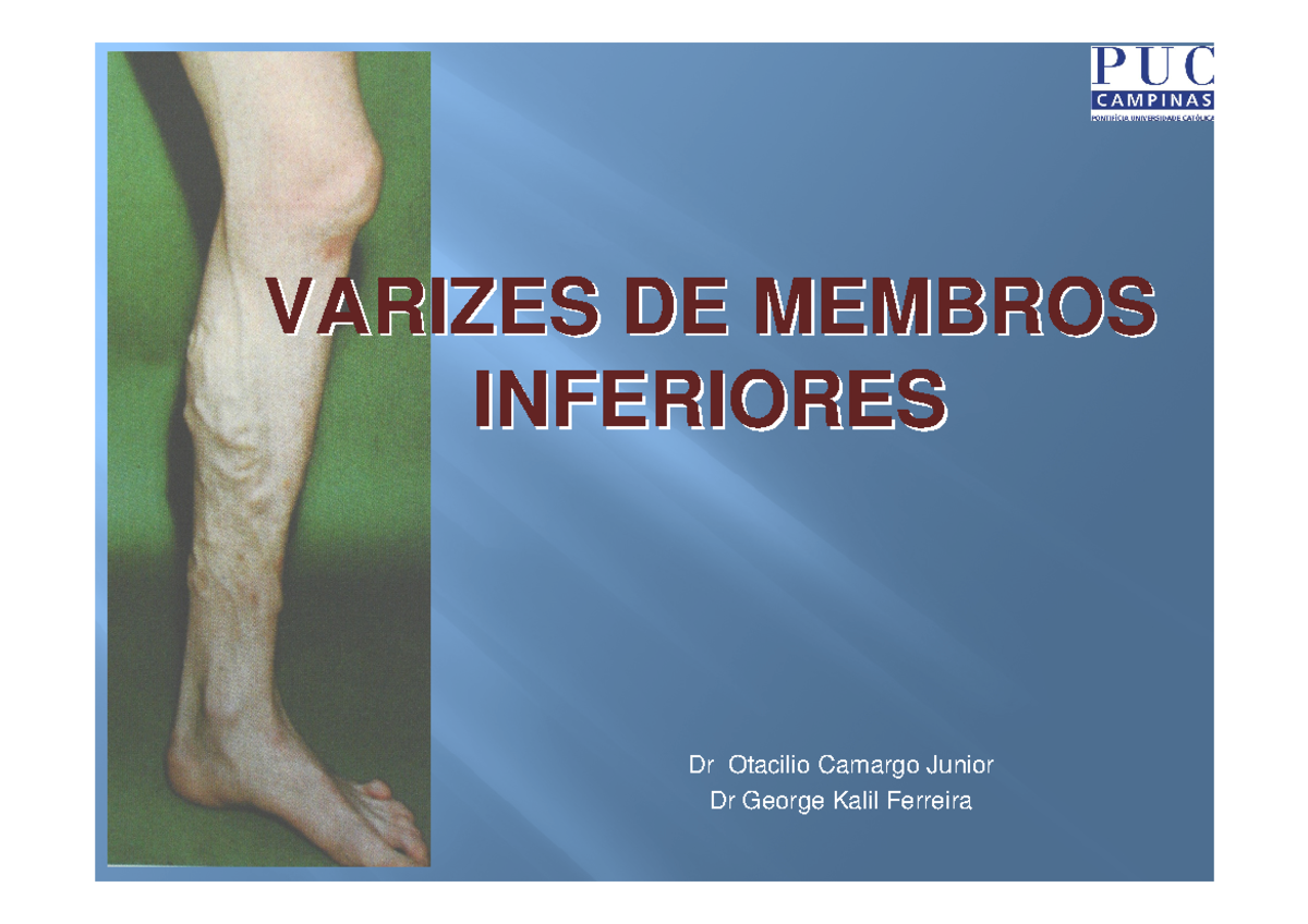 Varizes - Xxxxxxxcc - VARIZES DE MEMBROSVARIZES DE MEMBROS INFERIORES ...