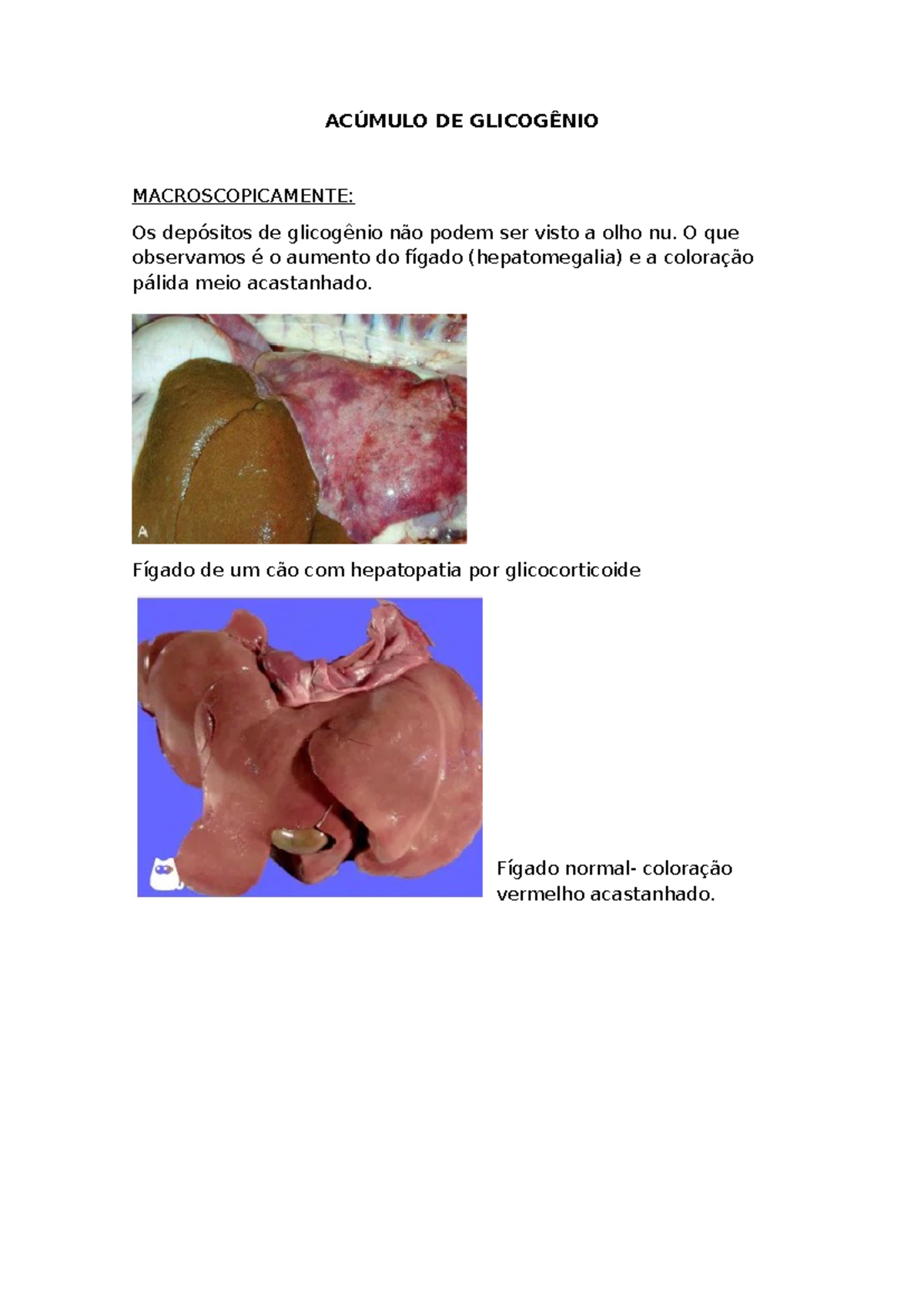 Acúmulo DE Glicogênio - Resumo Patologia geral - ACÚMULO DE GLICOGÊNIO ...