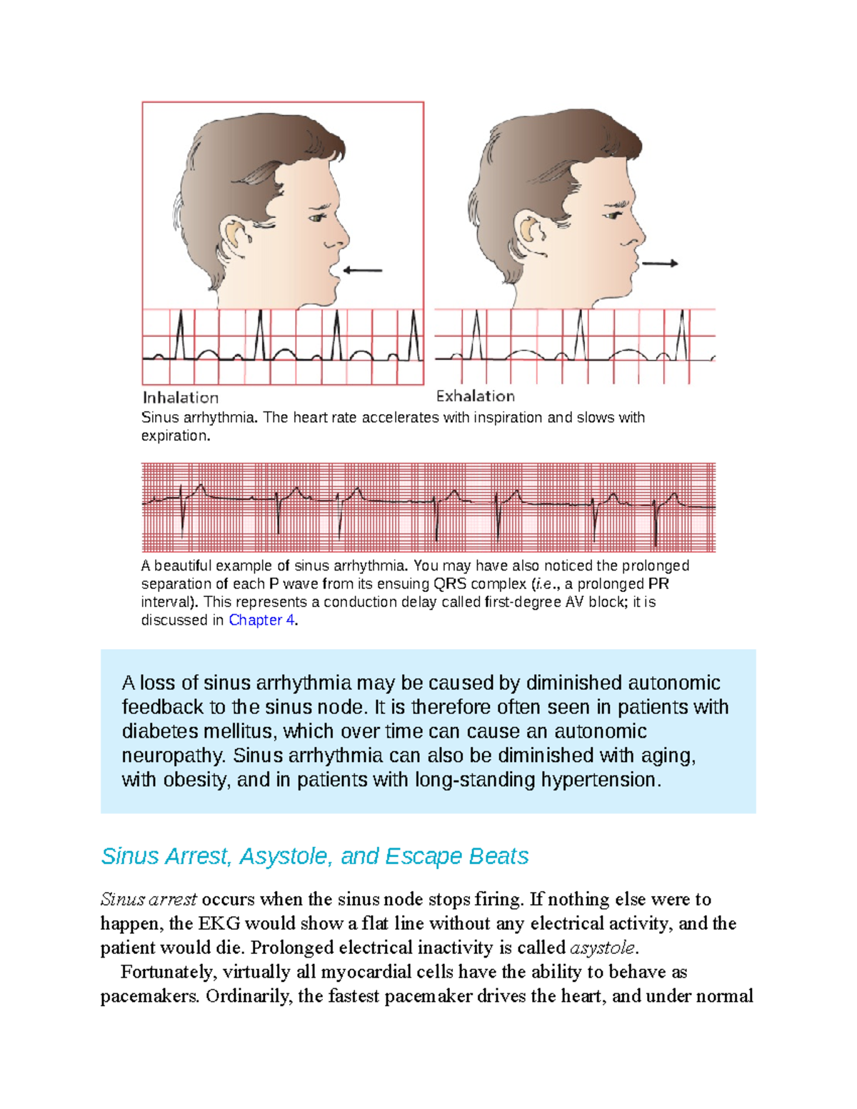 The only EKG-44 - Sinus arrhythmia. The heart rate accelerates with ...