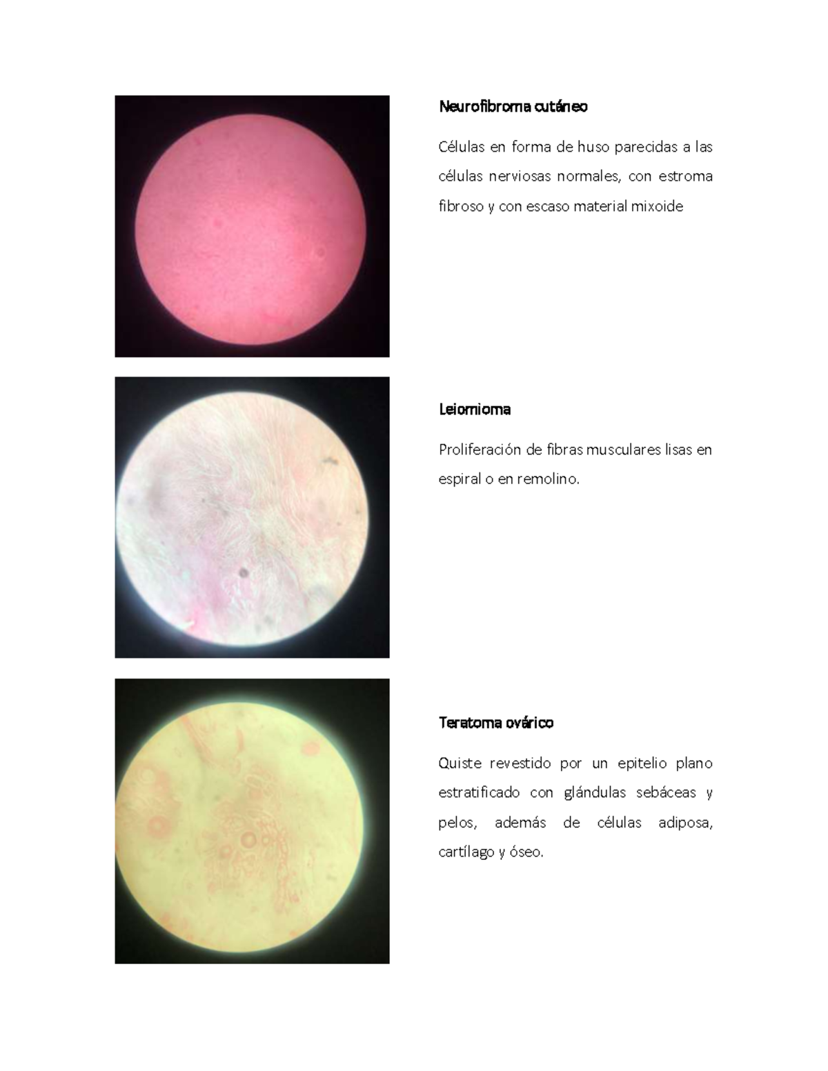 Microscopía de Neoplasias - Neurofibroma cutáneo Células en forma de ...