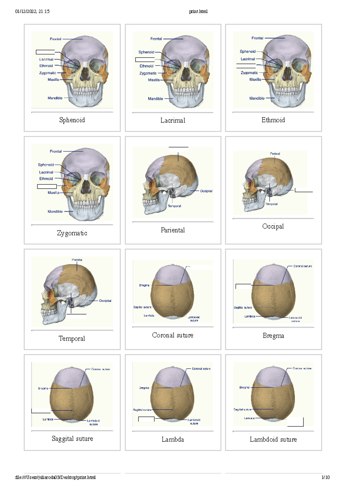 Cranium anatomy - Sphenoid Lacrimal Ethmoid Zygomatic Pariental Occipal ...