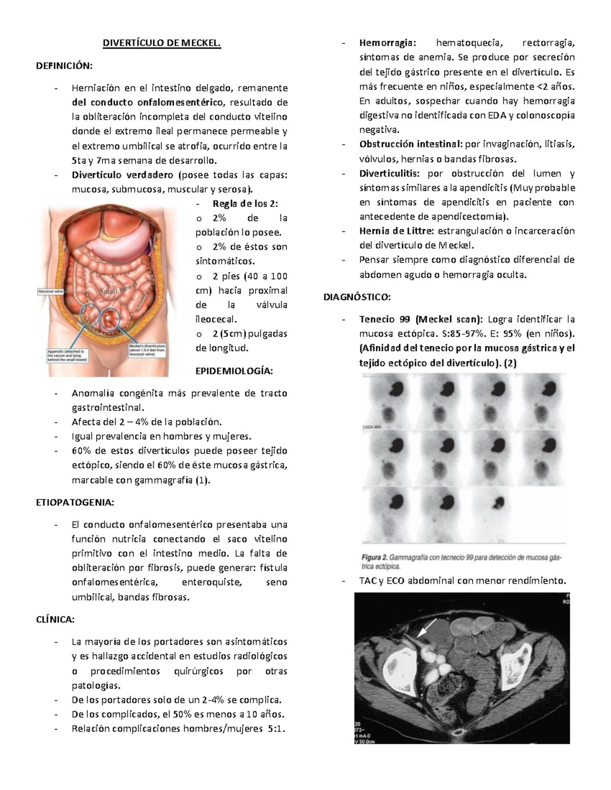 Divertículo DE Meckel - Resumen - DIVERTÍCULO DE MECKEL. DEFINICIÓN ...