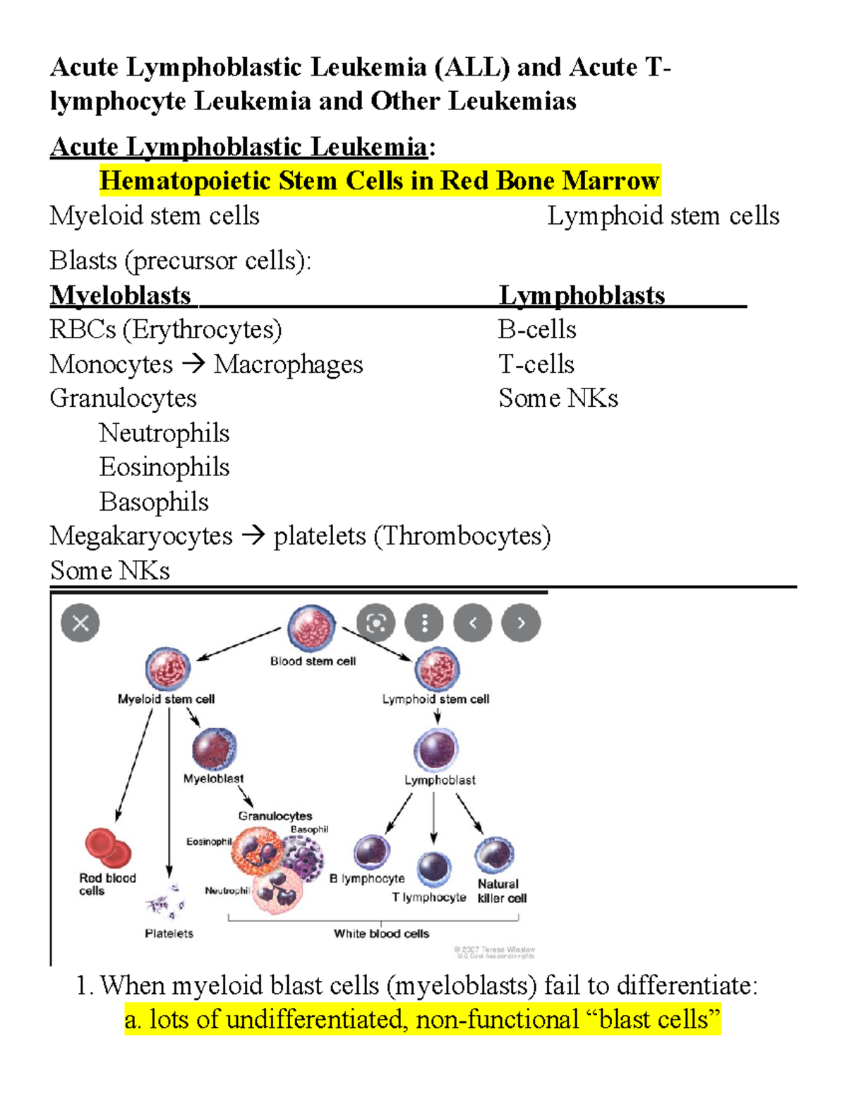 Acute Lymphoblastic Leukemia Summary Highlighted - Acute Lymphoblastic ...