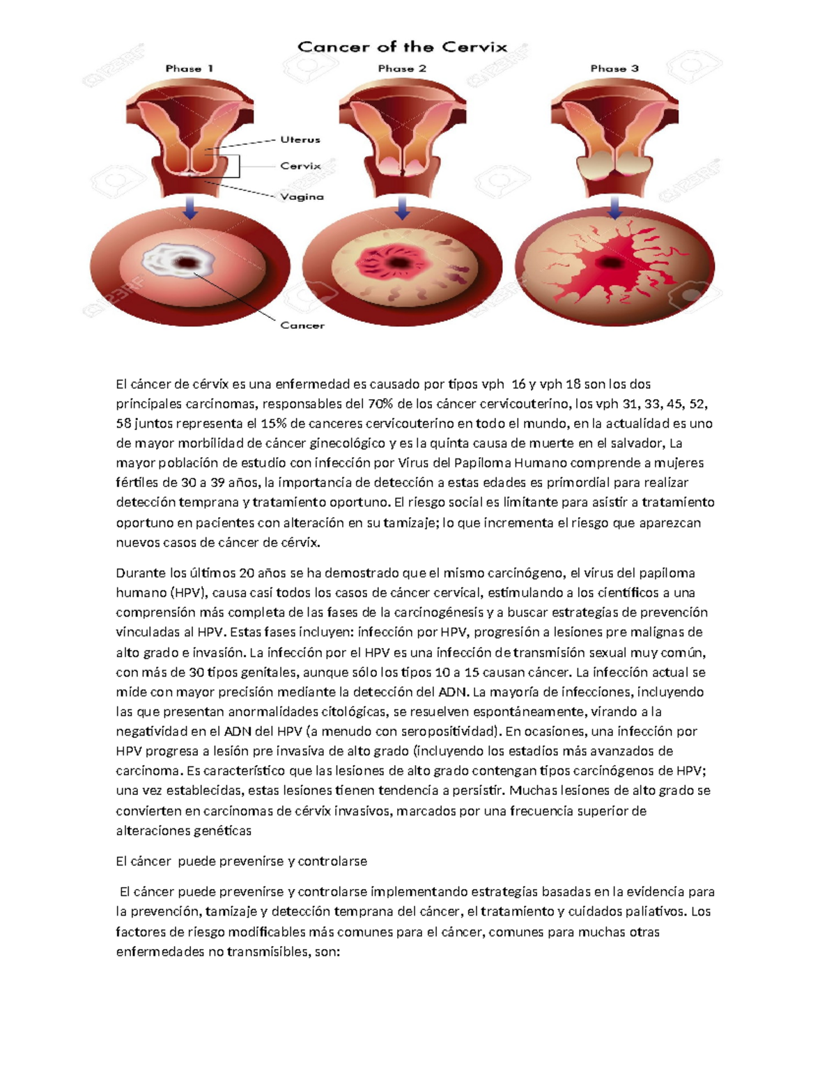 Cancer de cervix - nxajsocpakc - El cáncer de cérvix es una enfermedad ...