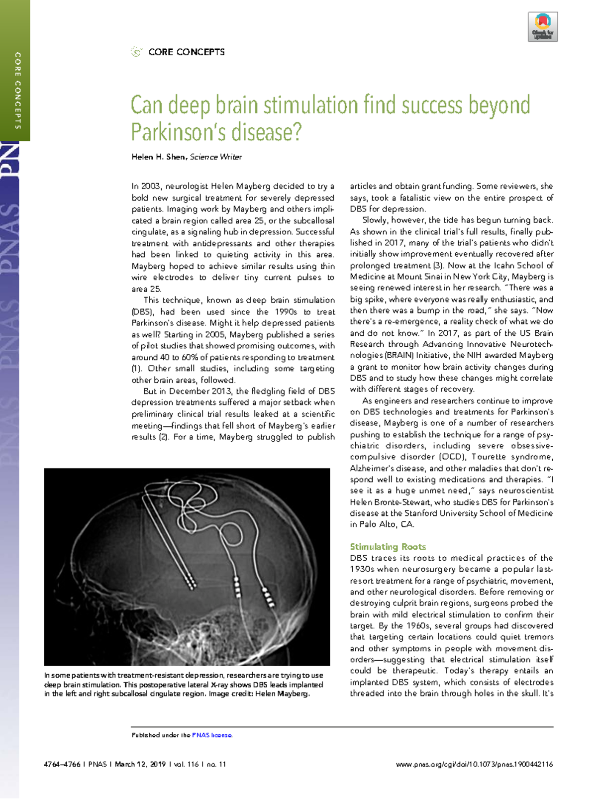 DBS find success beyond Parkinson's - CORE CONCEPTS Can deep brain ...