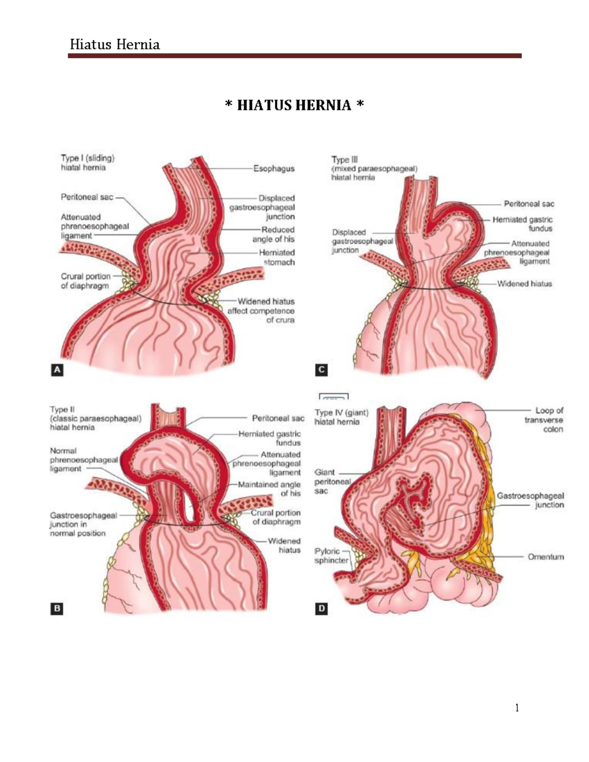 Hiatus Hernia - GIT surgery - * HIATUS HERNIA * Definition: Herniation ...