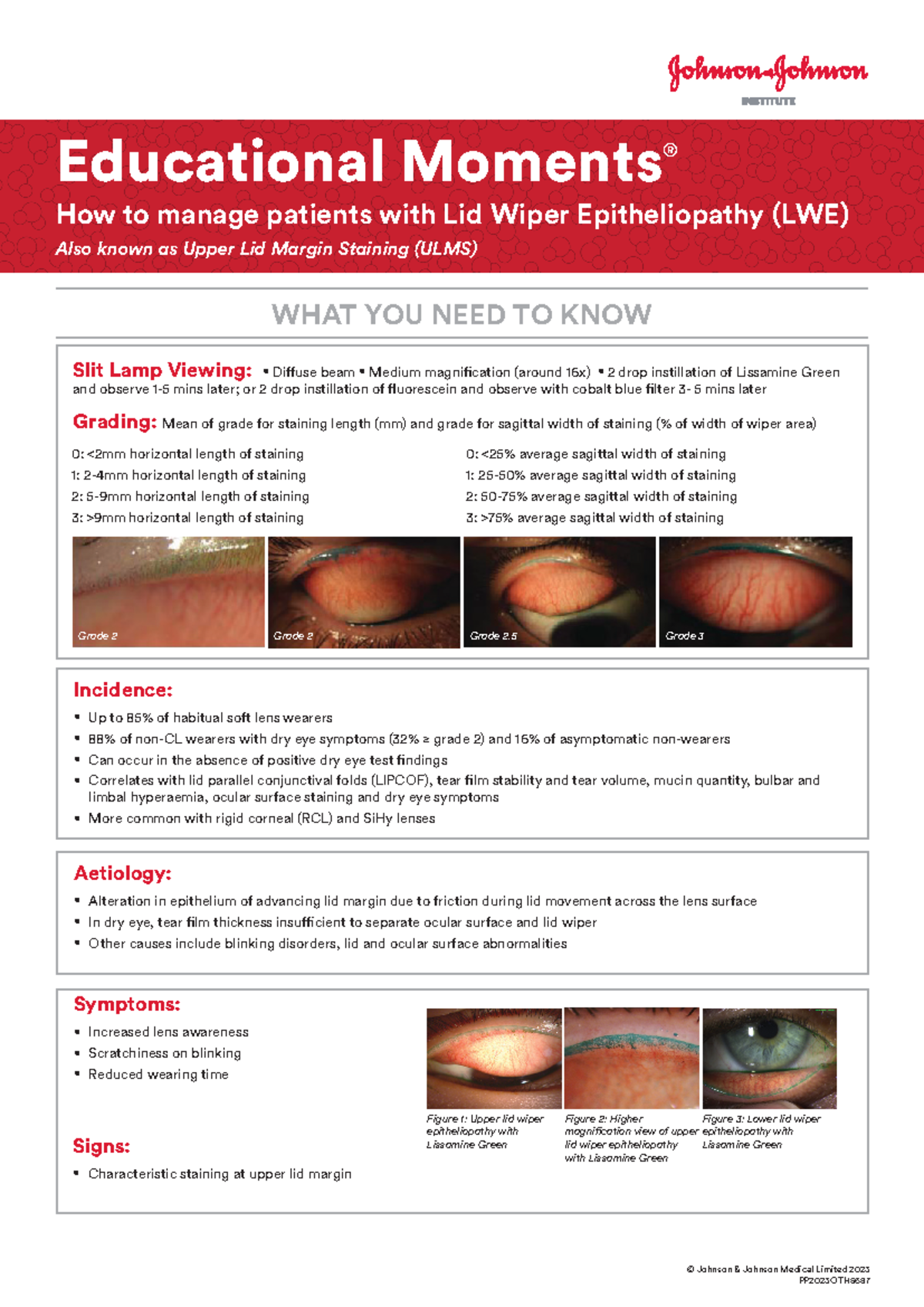 LID Wiper Epitheliopathy - Staining associated with Marx line (left ...