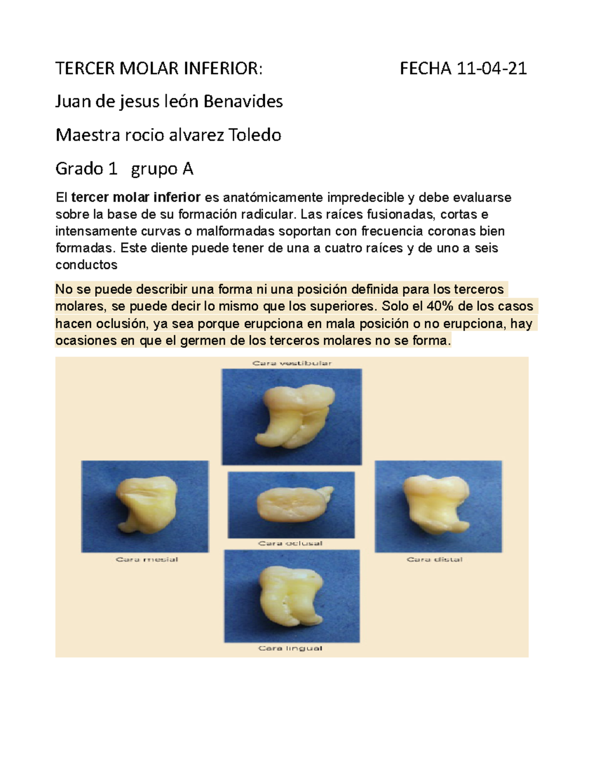 Tercer Molar Inferior - INFORMACION - TERCER MOLAR INFERIOR: FECHA 11 ...