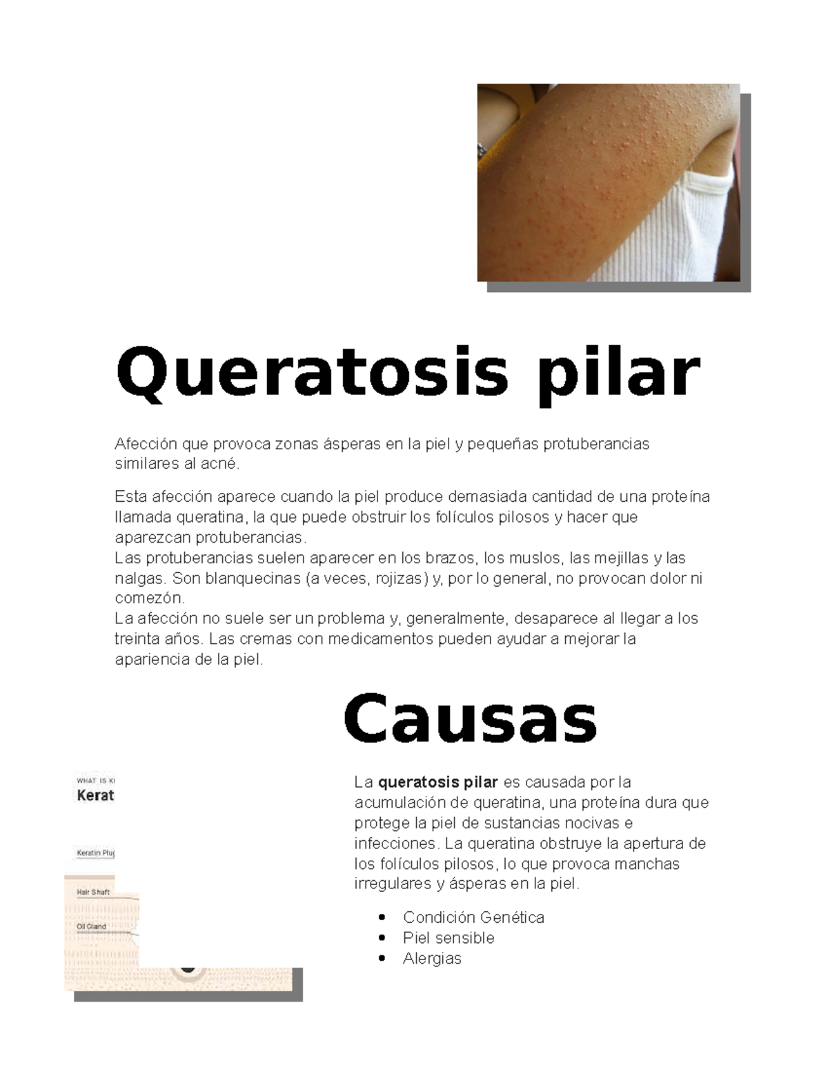 Queratosis Pilar - Queratosis pilar Afección que provoca zonas ásperas ...