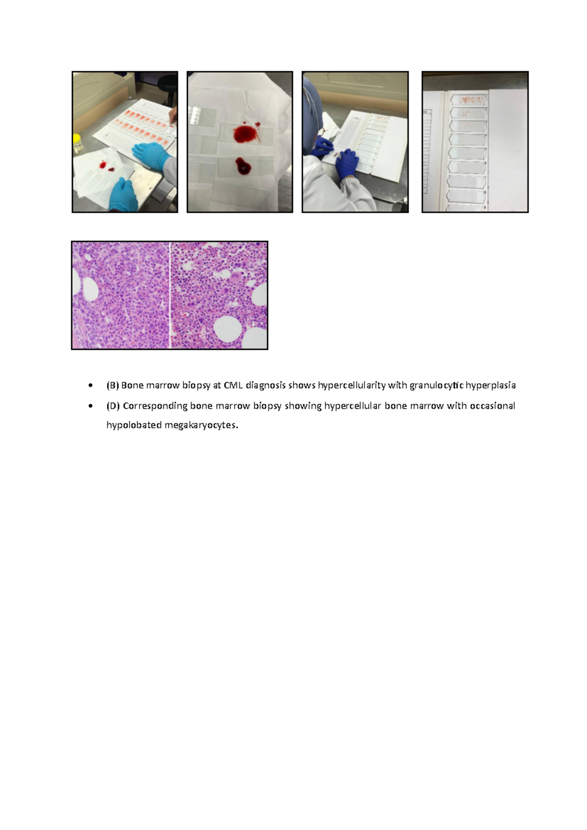 Haema - Hema notes - Clinical Microbiology and Practices - (B) Bone ...