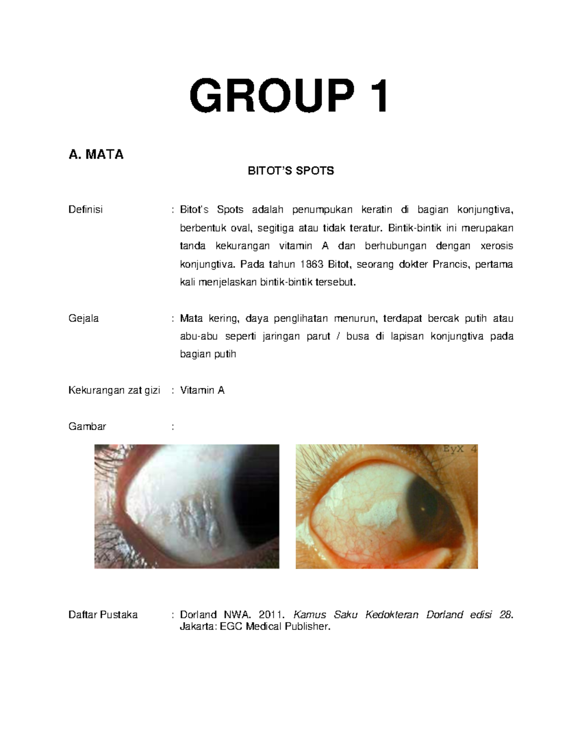 Nutritional Disorders - GROUP 1 A. MATA BITOT’S SPOTS Definisi : Bitot ...