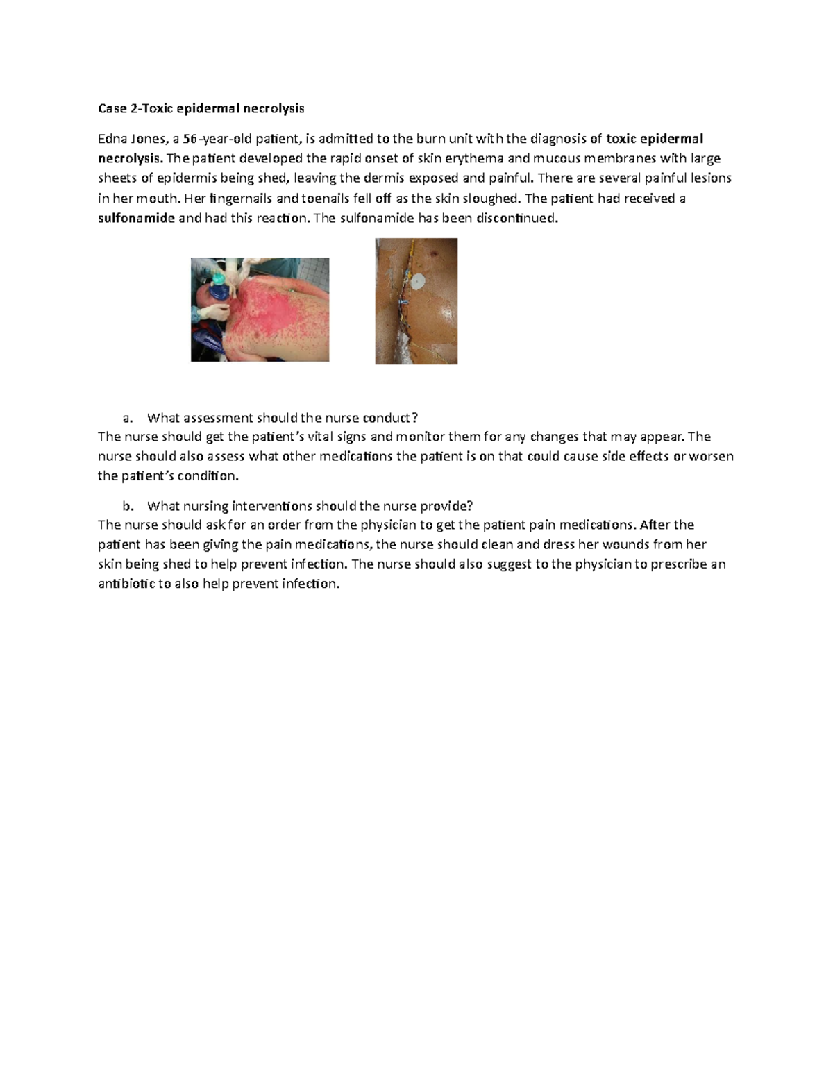 CASE Study 2-Integumentary - Case 2-Toxic epidermal necrolysis Edna ...