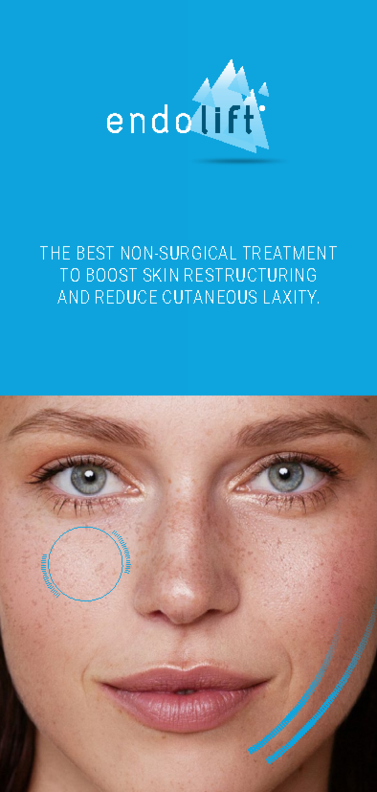 Endolift Patients - THE BEST NON-SURGICAL TREATMENT TO BOOST SKIN ...