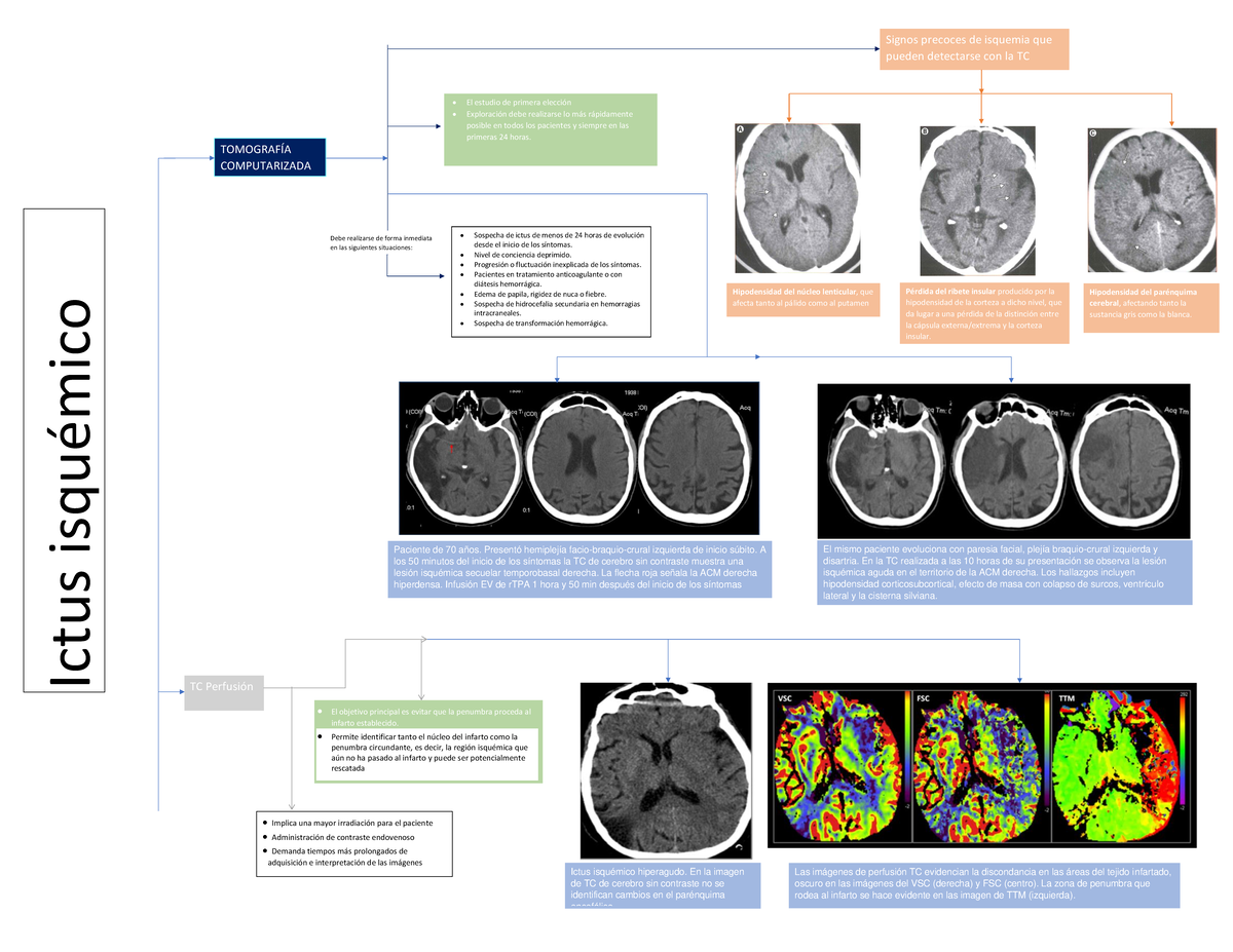 Esquema de estudios imagnologicas en el ictus isquemico - Sospecha de ictus de menos de 24 horas ...